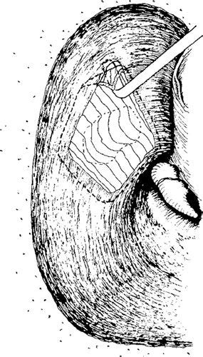 Basic Mastoidectomy Techniques Ento Key Basic Mastoidectomy Techniques Ento Key