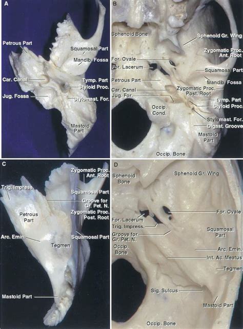 Temporal Bone Neuroanatomy The Neurosurgical Atlas