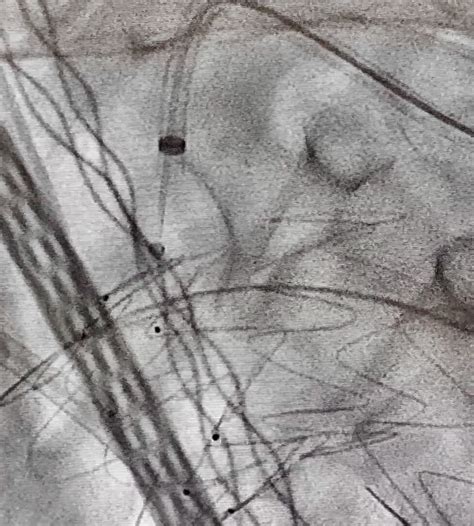 In Order To Celebrate Our 70th Complex Aorta Case And The Visit Of Our