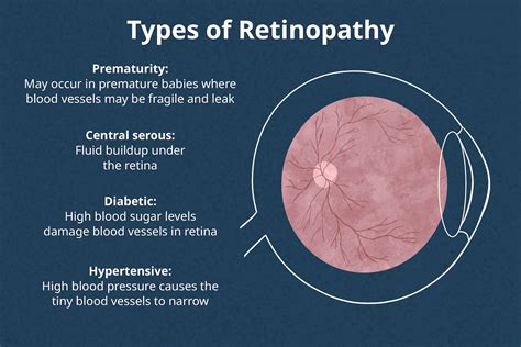 Hypertensive Retinopathy Vs Diabetic Retinopathy