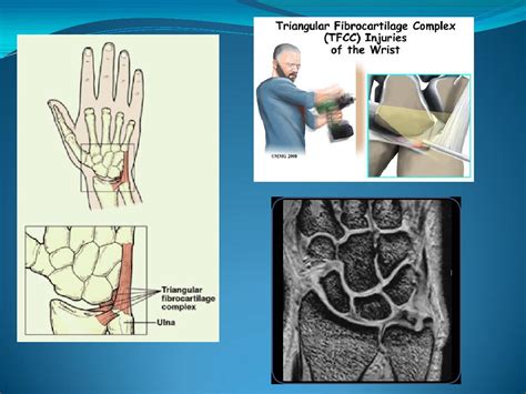 Tfcc Musculoskeletal System Limbs Anatomy