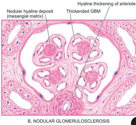 Diabetic Glomerulosclerosis Medizzy