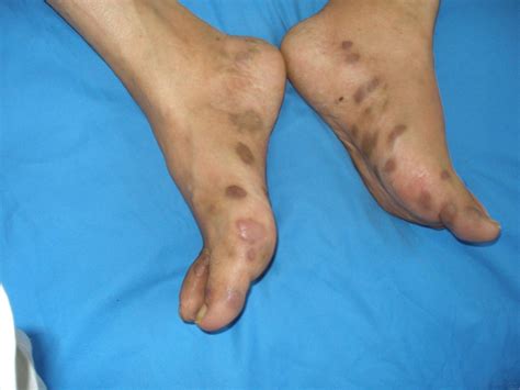 皮肤结核结节皮肤结核皮肤结核结节图片第10页大山谷图库