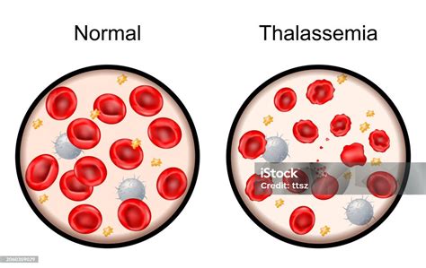 Thalassemia Closeup Of Red Blood Cells Stock Illustration Download