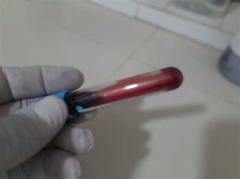 Lupus Anticoagulant Profile Introduction Archives Medical Notes