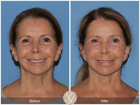 Preservation Deep Plane Facelift Case 44 Before And After Photos In