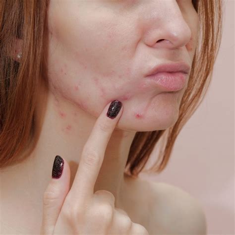 Common Signs Of An Underactive Thyroid In Teenagers The Lucy Rose Clinic