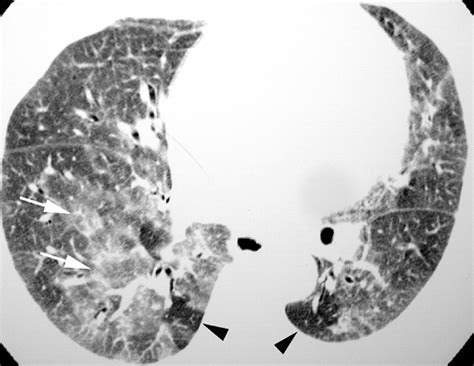 Challenges In Pulmonary Fibrosis · 1 Use Of High Resolution Ct