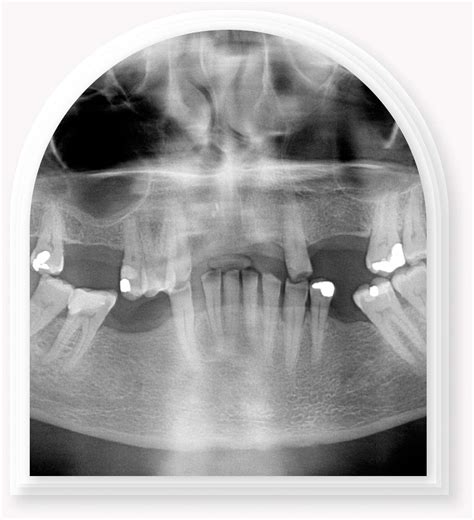 Missing Teeth Solutions Warrnambool Smile Dental