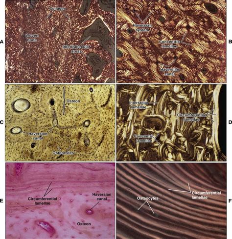 Woven Bone Vs Lamellar Bone