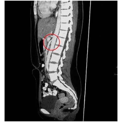 Narrow Aortomesenteric Angle 10° And Aortomesenteric Distance 6 Mm Download Scientific