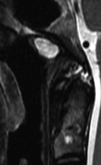 Tornwaldt Zyste Pacs