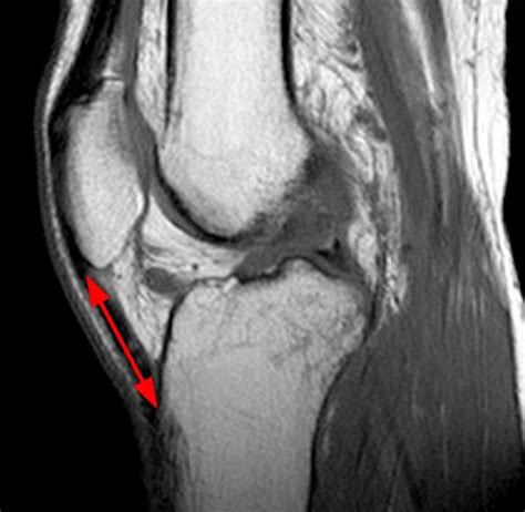 Arthrofibrosis Of The Knee Radsource