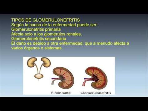 Profesora Adriana Mendez Clase Glomerulonefritis Youtube