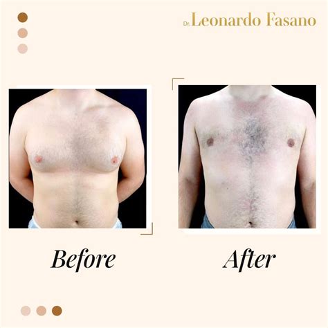 Check Out This Incredible Before And After Showing The Difference Vaser