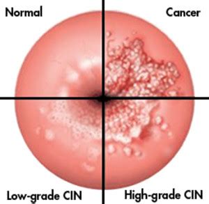 Does Abnormal Cells In Cervix Mean Cancer Cancerwalls