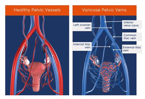 Pelvic Congestion Syndrome Sydney Vascular Surgeon