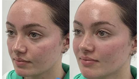 How To Get Rid Of Smokers Lines Lips Ams Aesthetics