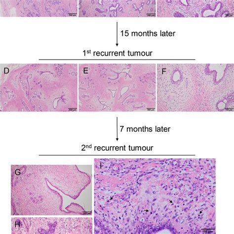 Phyllodes Tumours With Gland Rich Feature A Abundant Glands And