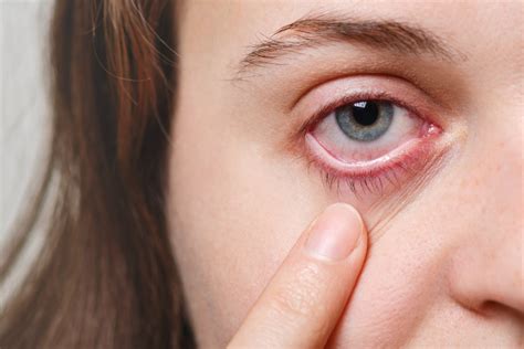 Itchy Eyes Why It Happens And How To Treat It
