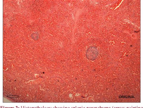 Figure 2 From Torsion Of A Splenule In A Case Of Splenogonadal Fusion