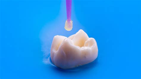 Bonding Teeth Procedure Bonding Dentaire Tarif Rrrm