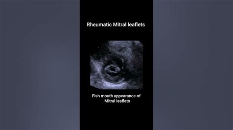 Echo Rheumatic Mitral Leaflets Youtube