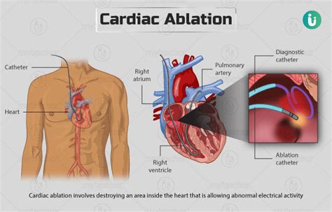 Cardiac Ablation Procedure Purpose Results Cost Price Indications