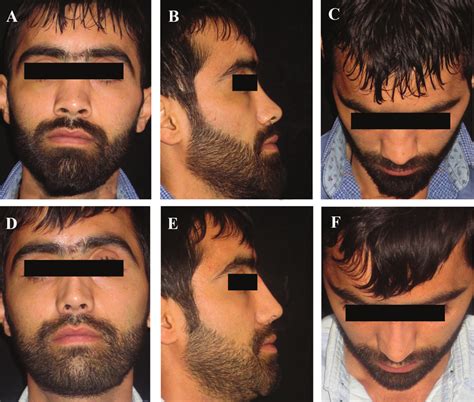 A 27 Year Old Man With Saddle Nose Deformity Due To Panfacial Fracture