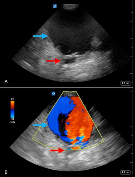 Ultrasound Assessment Of Postprocedural Arterial Pseudoaneurysms