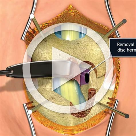 Medical Legal Exhibits Legal Animations And Trial Graphics