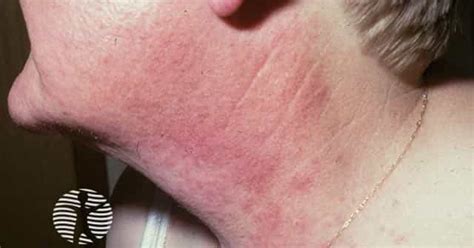 Drug Induced Photosensitivity Image