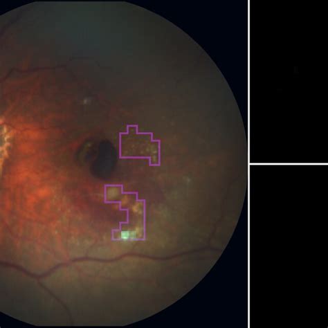 examples of lesion activation maps provided by the a l max models for