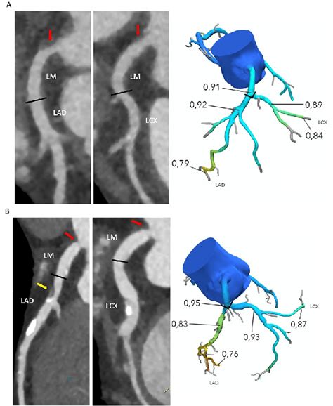 Ffr Ct Reading Strategy Examples Of Patients With Simple A Or Download Scientific Diagram