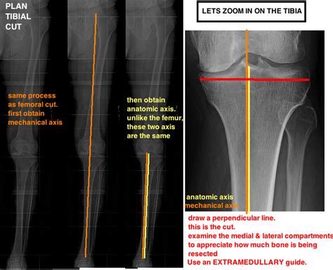 Tka Alignment — Hip And Knee Book