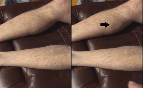Can Fasciculation Go Away Benign Fasciculation Syndrome Causes And