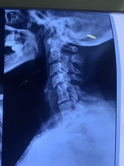 Is There A Cervical Rib In This Xray Rmedicalstudents