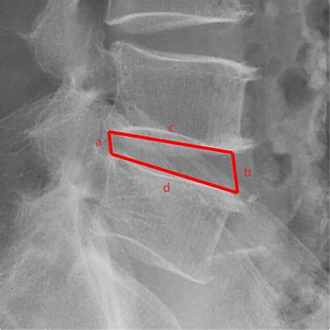 Rom Before Surgery Extension Download Scientific Diagram