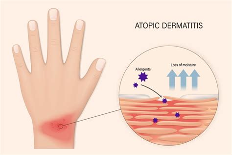 Atopic Dermatitis Vs Contact Dermatitis Expert Explains How To Differentiate Between The Two