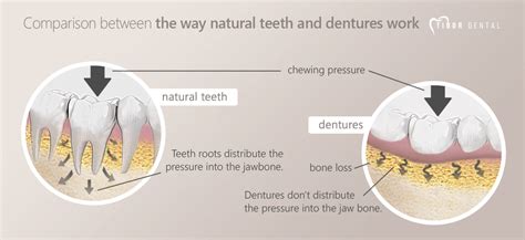 What Causes Bone Loss With Teeth At Becky Moreno Blog