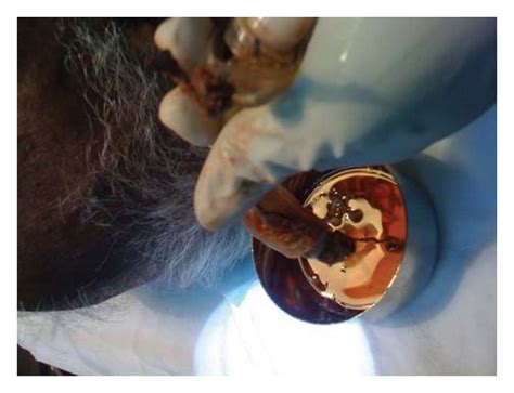 The Blocked Tracheostomy Tube At Presentation Download Scientific