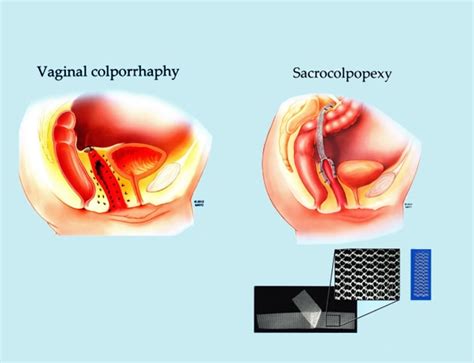 Pessary For Bladder Prolapse