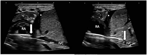 Safely Repositioning Dual Lumen Ecmo Cannulas With A Transfemoral Lasso