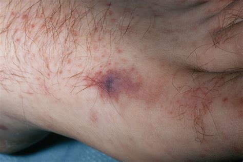Ecchymosis Vs Petechiae Senile Purpura