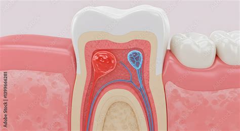 Detailed 3d Model Of A Tooth With Pulpitis And Apical Periodontitis A