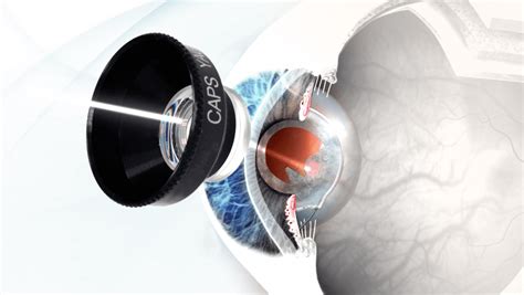 Cataracte Secondaire Opération De La Cataracte Secondaire à Orange