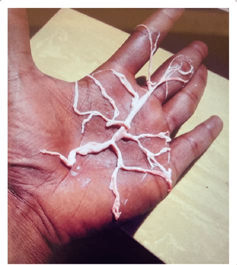 Bronchial Cast Expectorated By Patient And Unfolded To Reveal Download Scientific Diagram