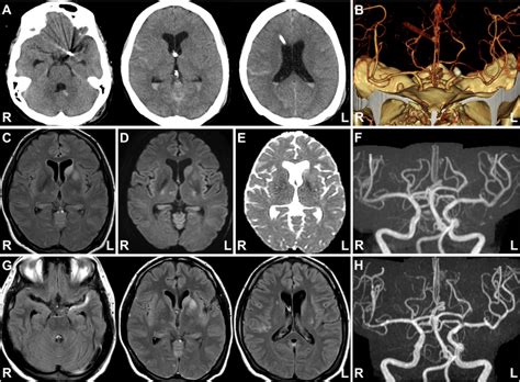 AB 5 A CT B CT Angiography C F 9 FLAIR C DWI D ADC E F MRA GH 15 G Download Scientific Diagram