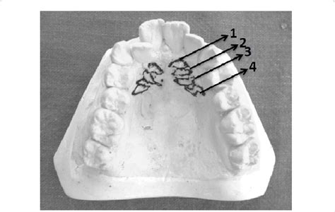 Primary Secondary And Fragmentary Rugae Traced On Each Side Of Mid Download Scientific Diagram