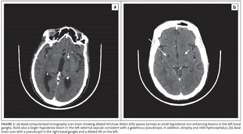 Computerised Tomography Findings In Hiv Associated Cryptococcal